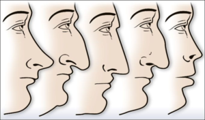 The Greek Nose Shape | Snoring Devices Australia